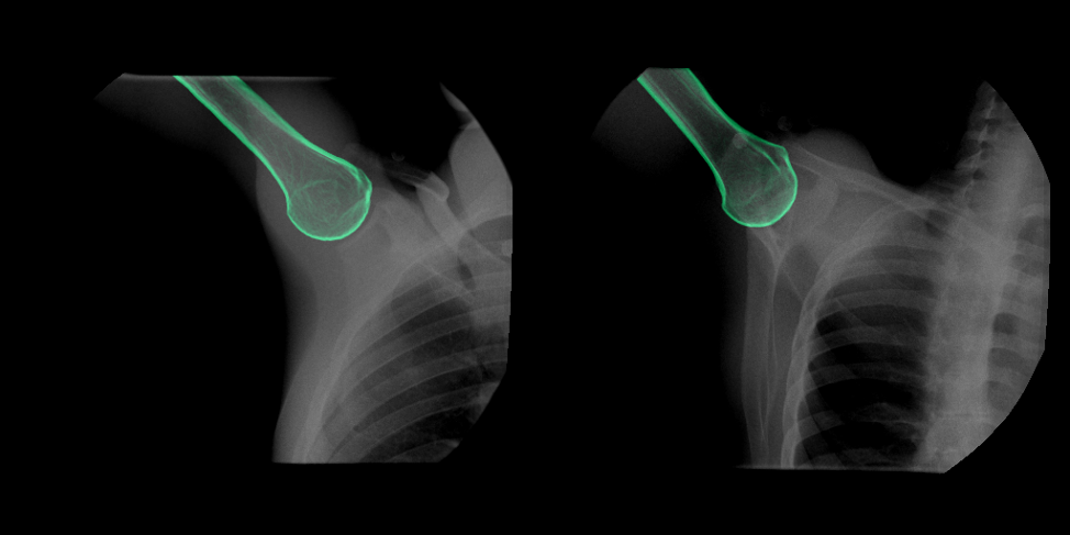 Arthroscopic Superior Capsular Reconstruction | UPMC Physician Resources
