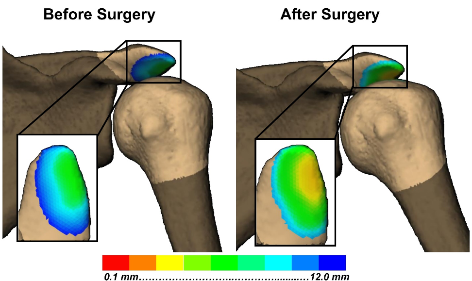 Arthroscopic Superior Capsular Reconstruction | UPMC Physician Resources