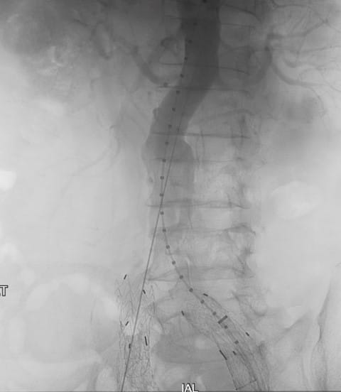 Bilateral IBE Vasc Rounds Summer 19 | UPMC Physician Resources